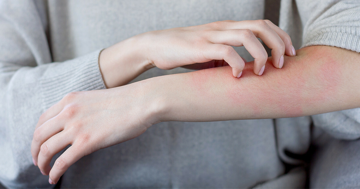 Scabies study | Institute of Tropical Medicine